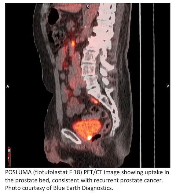 POSLUMA May Help Identify Recurrence of Prostate Cancer After Radical ...