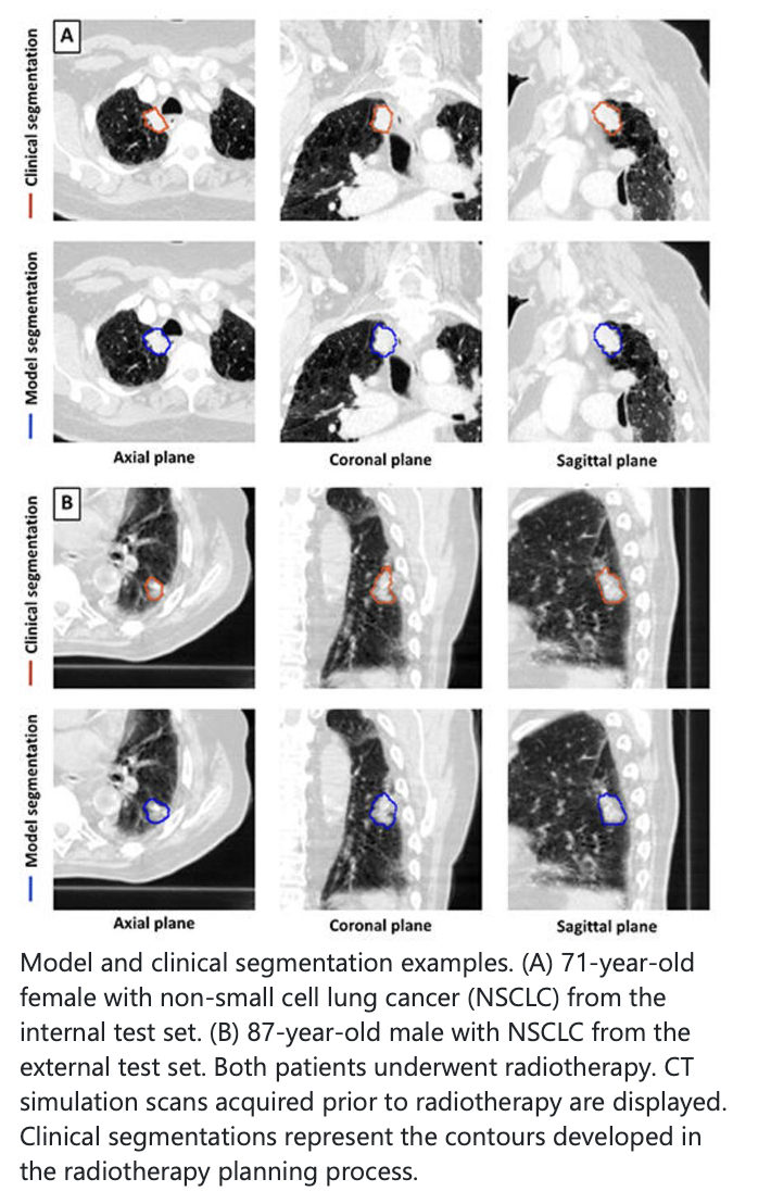 Deep-Learning Model Helps Detect Lung Tumors Using CT Scans | Applied ...