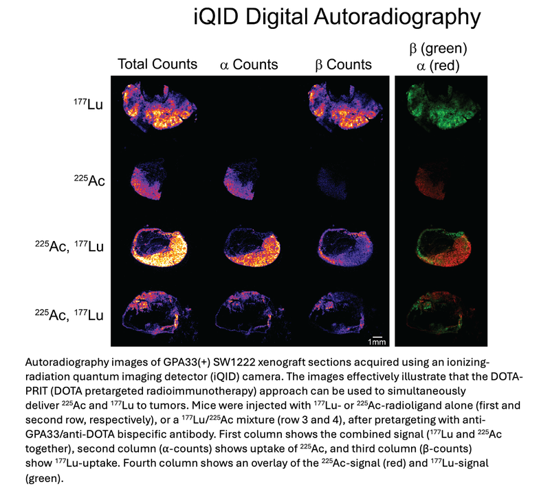 Dual-Isotope Radionuclide Therapy Safe, Effective in Colorectal Cancer ...