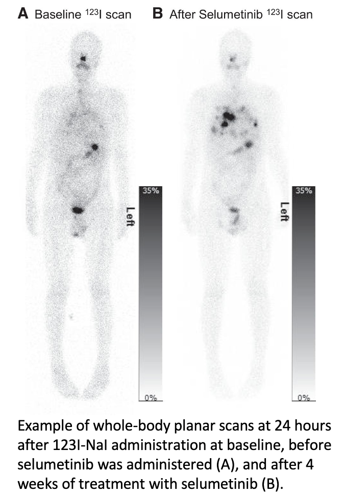 Pretherapy Imaging and Dosimetry Personalizes Treatment Planning for ...