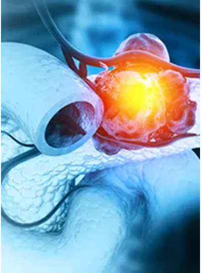 COMPETE Trial Data Shows 177Lu-edotreotide Improves Progression-Free ...