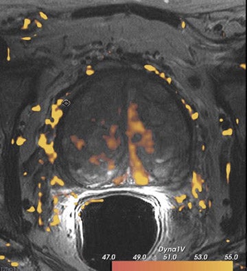 MRI Can Help Differentiate Clinically Significant Prostate Cancer in PI ...