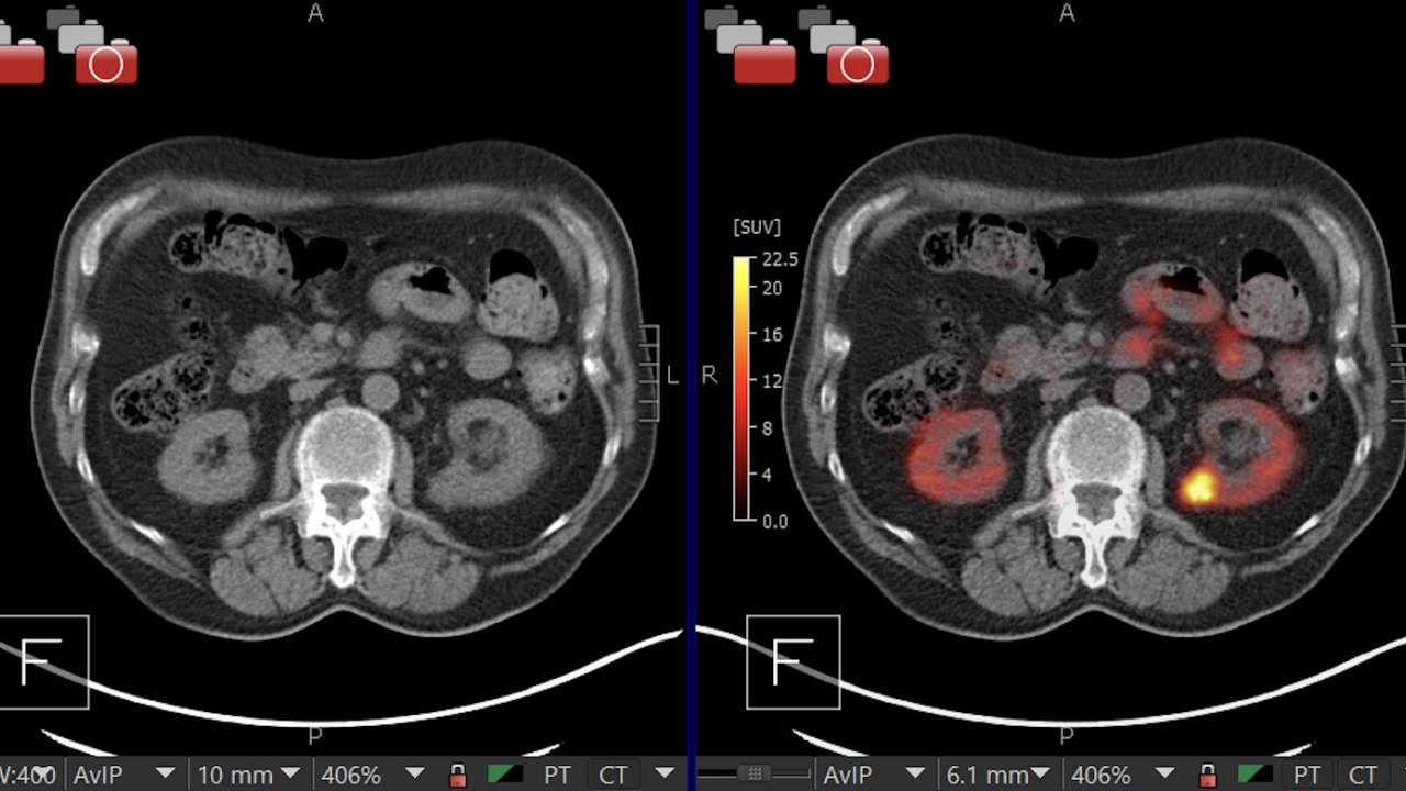 PET Imaging Method Accurately Detects Aggressive Kidney Cancer ...