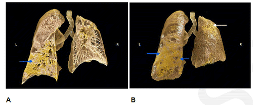 New Images Show CT Cinematic Rendering of SARS-CoV-2 Pneumonia ...
