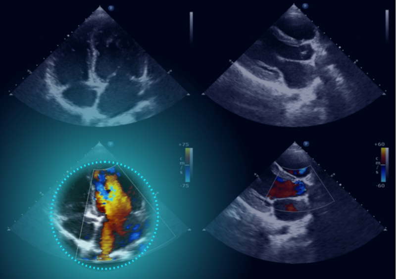 Dyad’s AI-Powered Echocardiogram Analysis Program Gets FDA Clearance ...