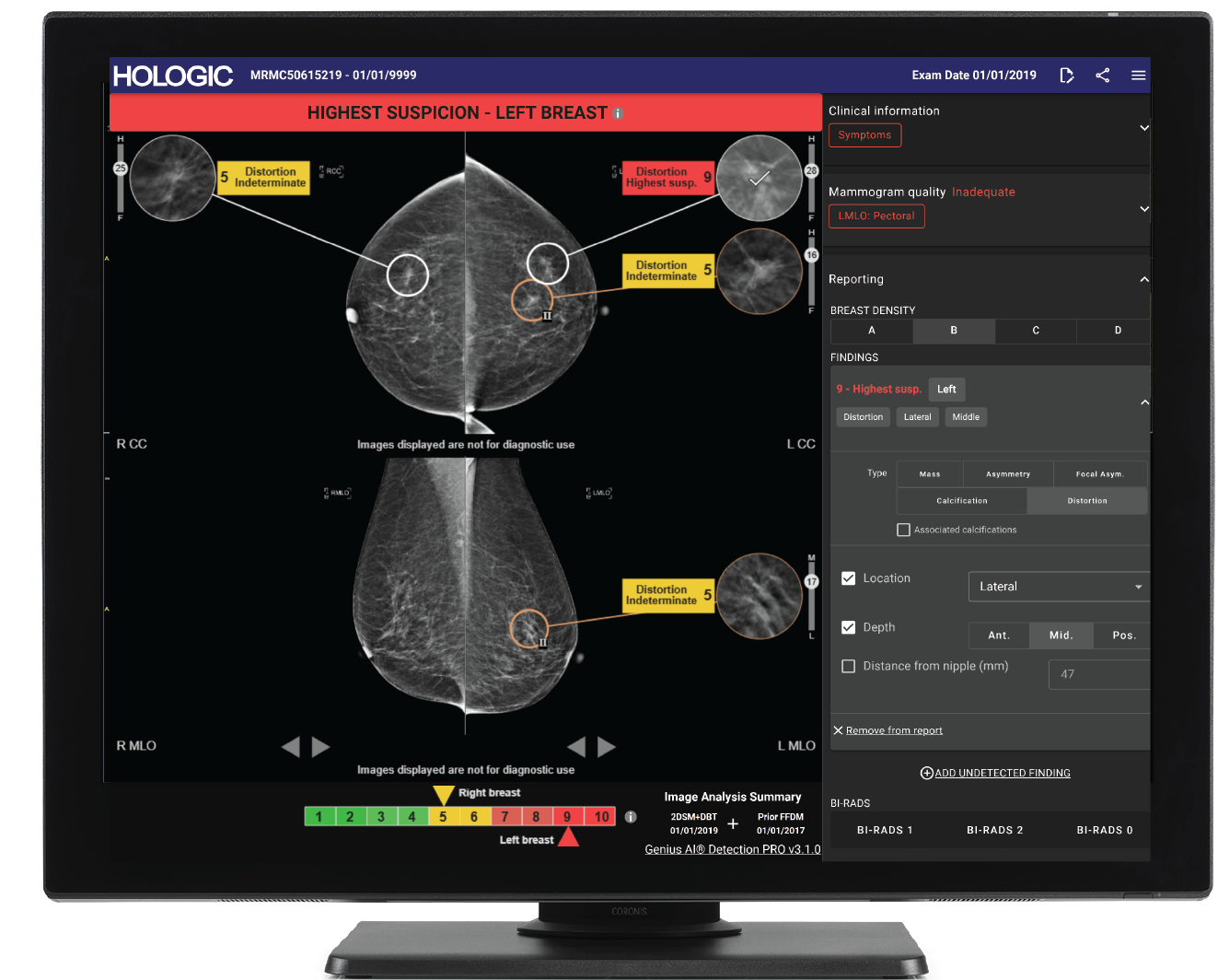 Hologic's AI-Enhanced Technology Preserves Mammography Accuracy While ...