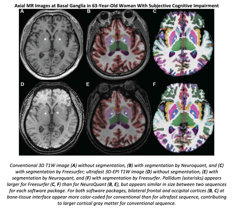 Ultrafast 3D T1W Compares to Conventional 3D T1W yet Shows Bias in ...