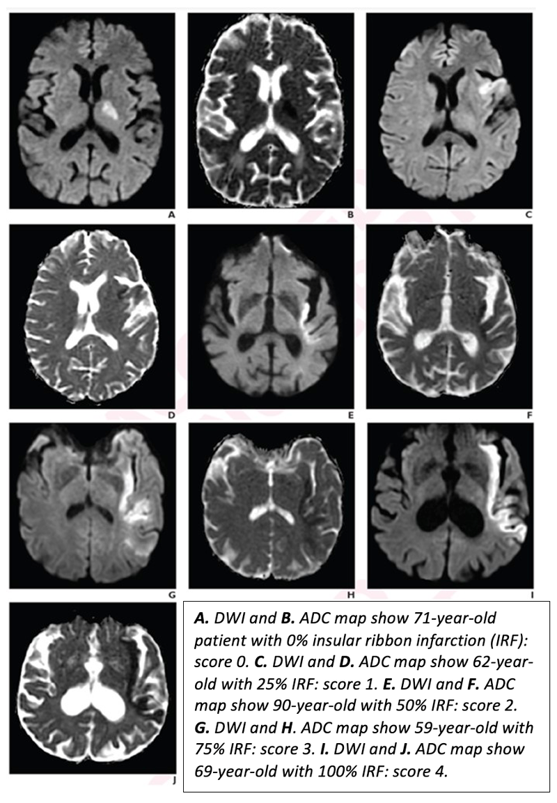 Percent Insular Ribbon Infarction Predicts Infarct Growth Rate, Stroke ...