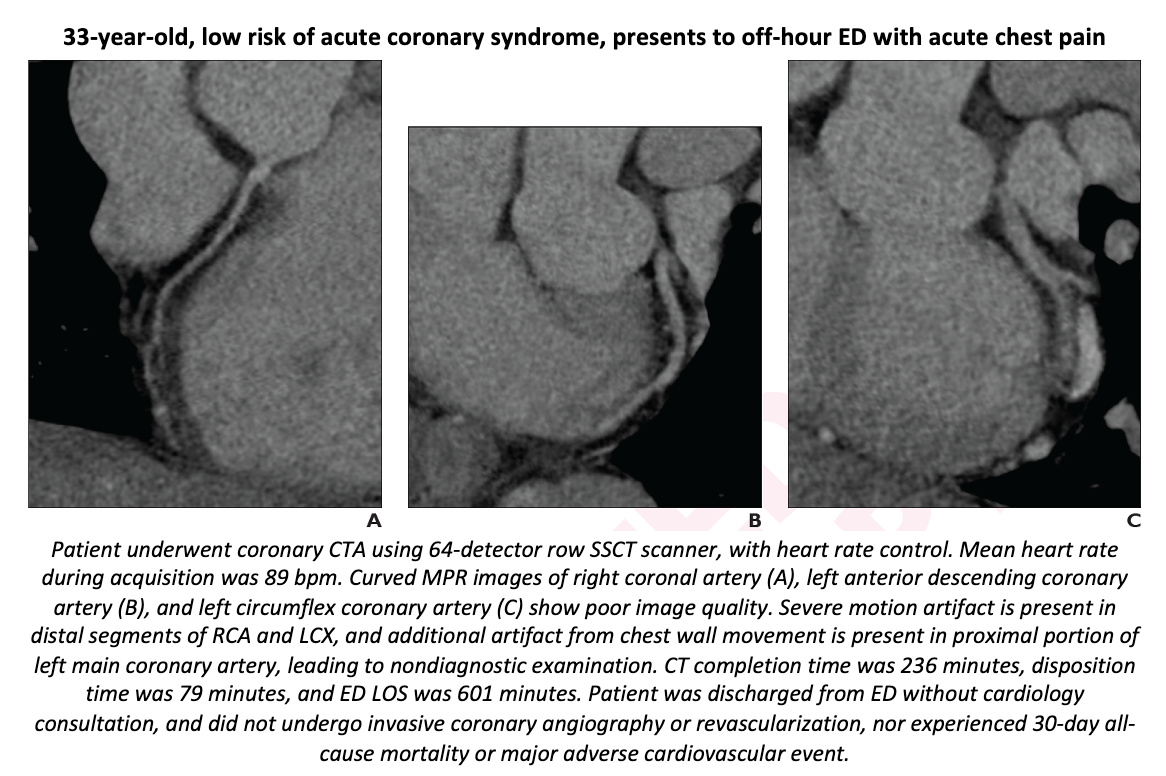 Dual-Source CT for Chest Pain Can Eliminate Use of Beta Blockers ...