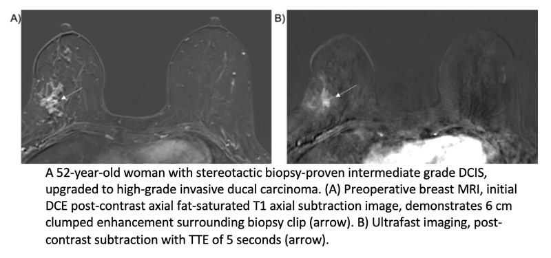 Preoperative Ultrafast MRI May Predict DCIS Upgrade to Invasive Cancer ...