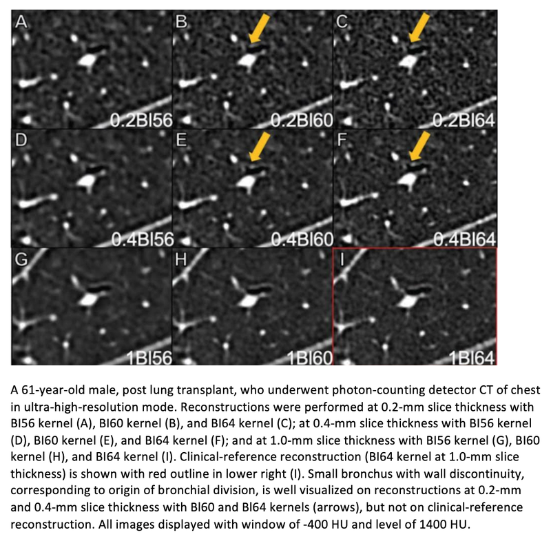 Kernel and Slice Thickness Matter in Photon-Counting CT Lung Imaging ...