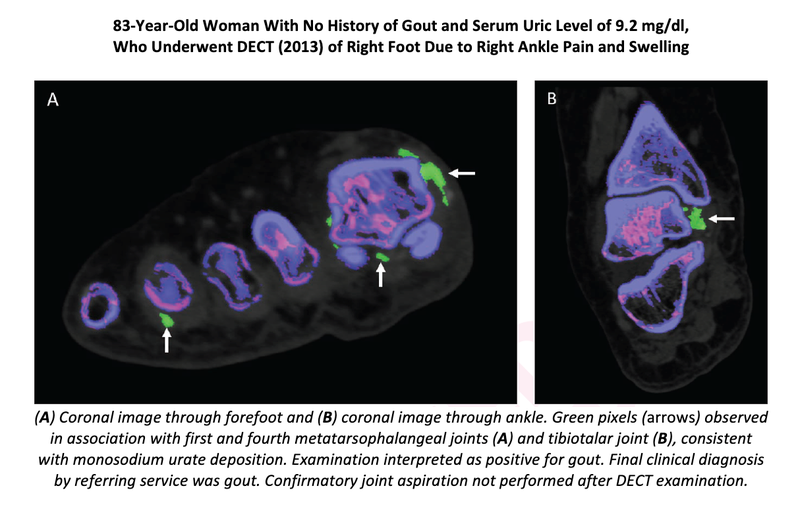 Adopting Dual-energy CT Leads to Lower Equivocal Interpretations in ...