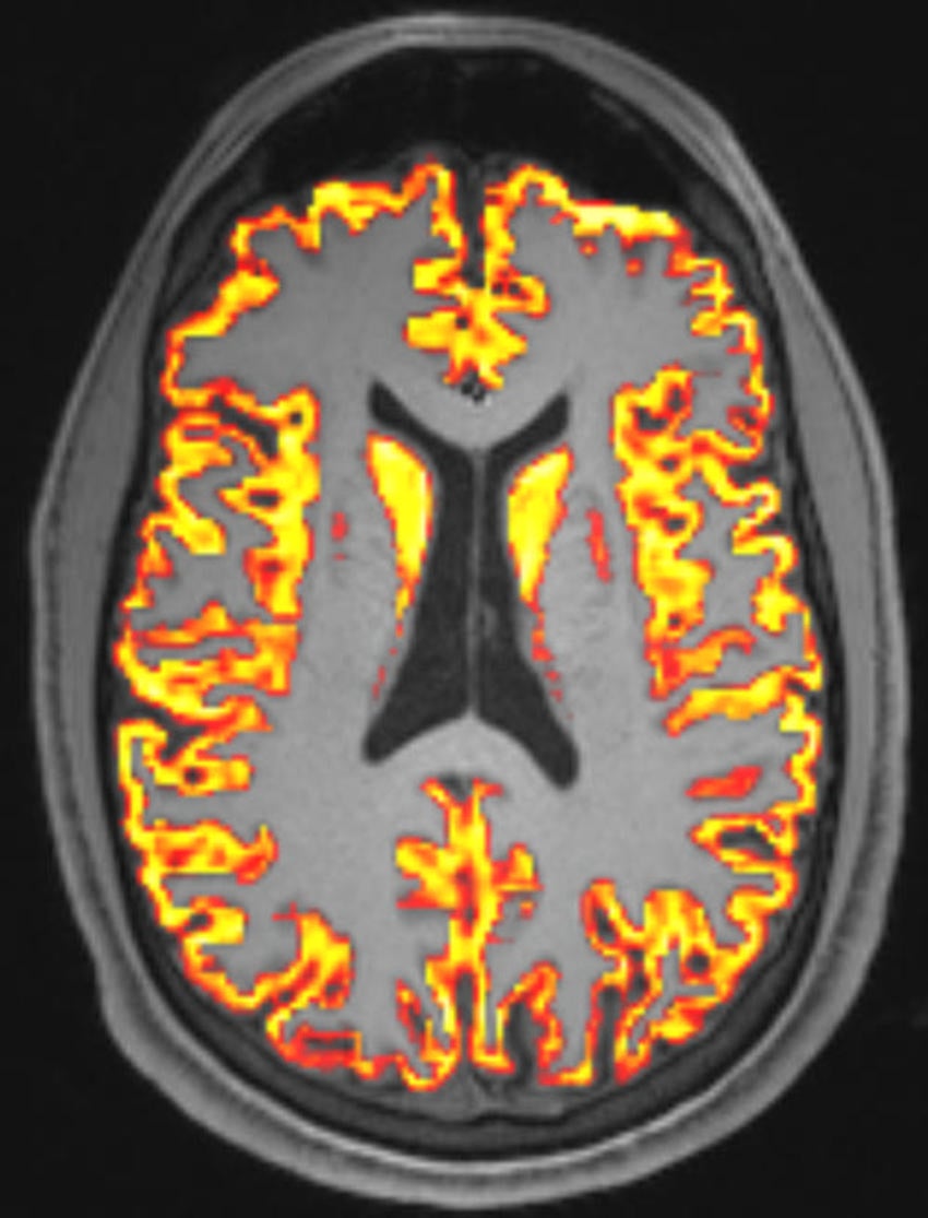 Diffusion MRI Detects Changes in the Brain After COVID-19 | Applied ...