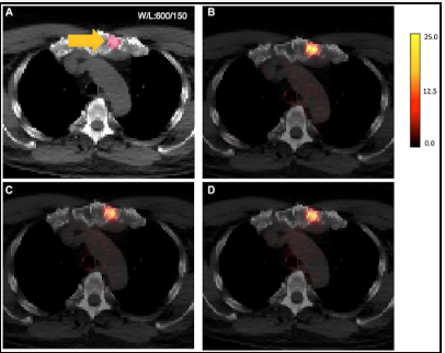 PET Biomarker Predicts Success of Immune Checkpoint Blockade Therapy ...