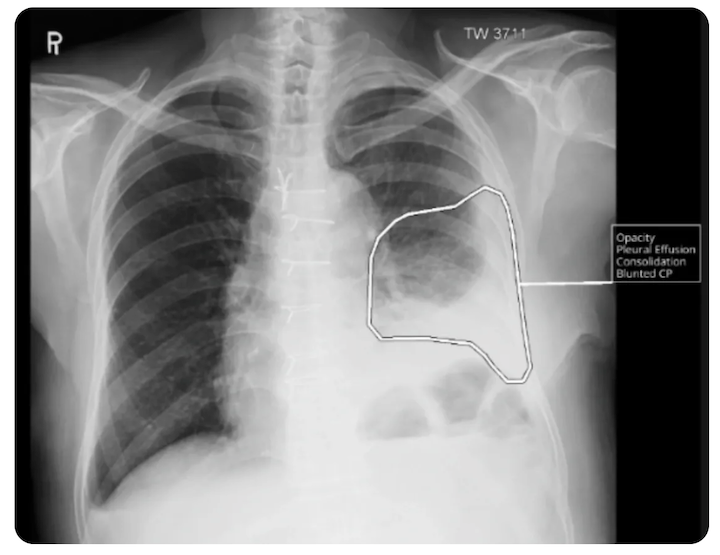 Radiologists Outperform AI in Detecting Lung Diseases With Chest X-ray ...
