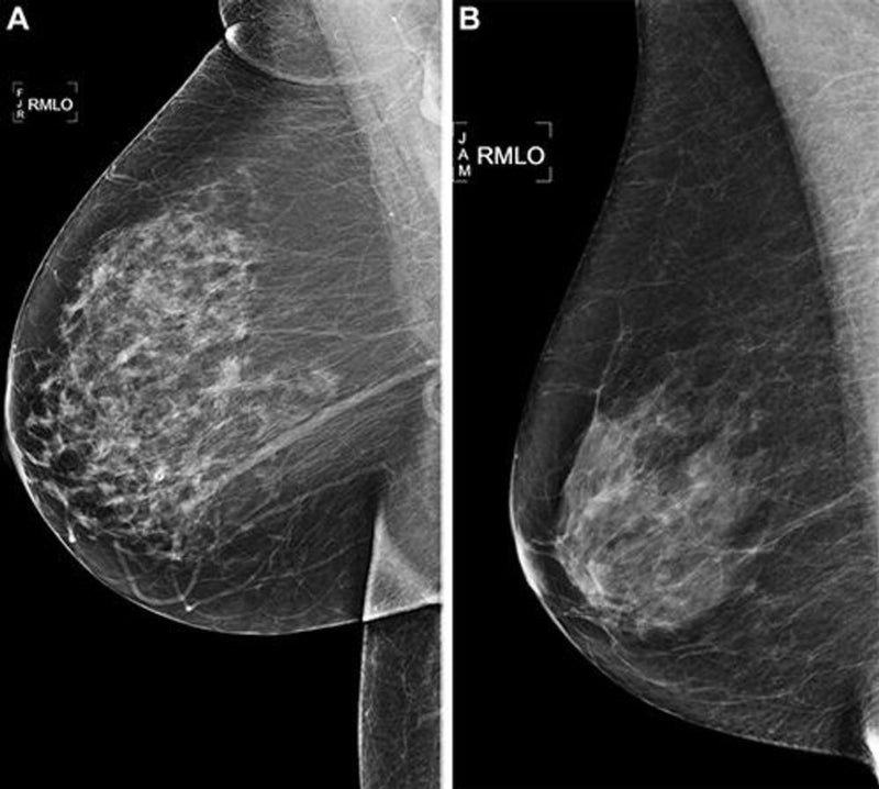 Tissue Stiffening in HER2-Negative Breast Cancer Can Drive Metastases ...