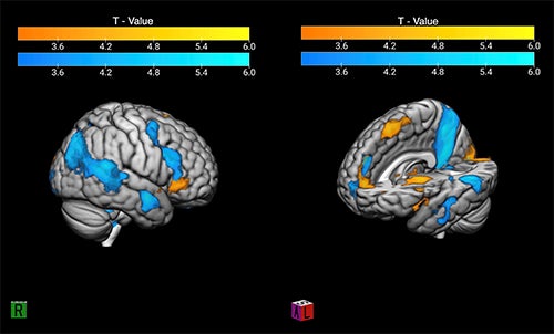 fMRI Finds Neural Patterns Differentiate Sad From Traumatic Memories in ...