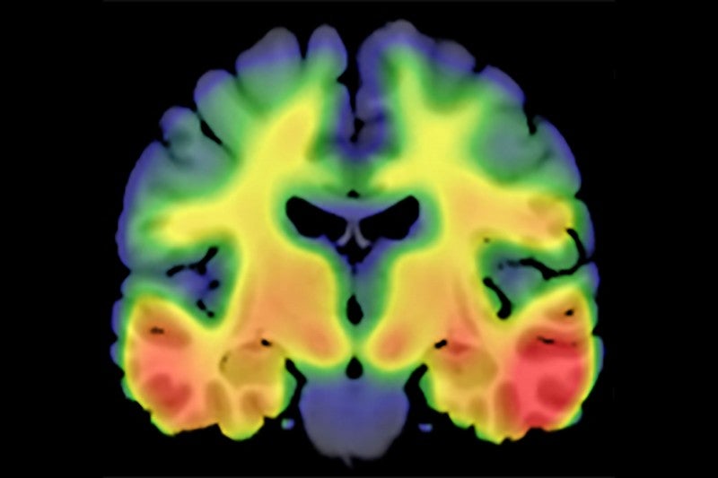 SNMMI, Alzheimer’s Association Update Appropriate Use Criteria for ...