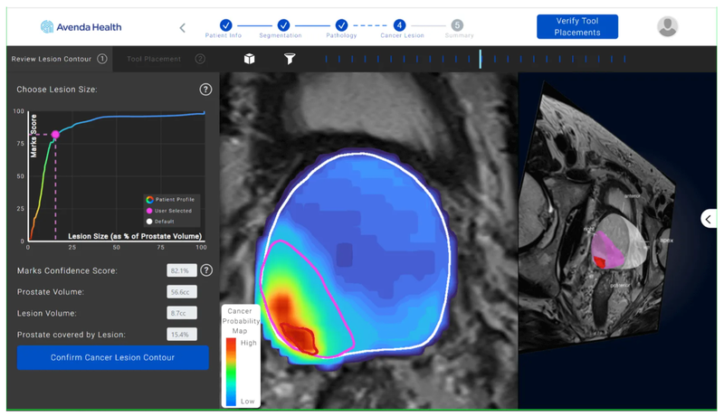 AI-Powered Prostate Cancer Precision Oncology Platform Receives FDA ...