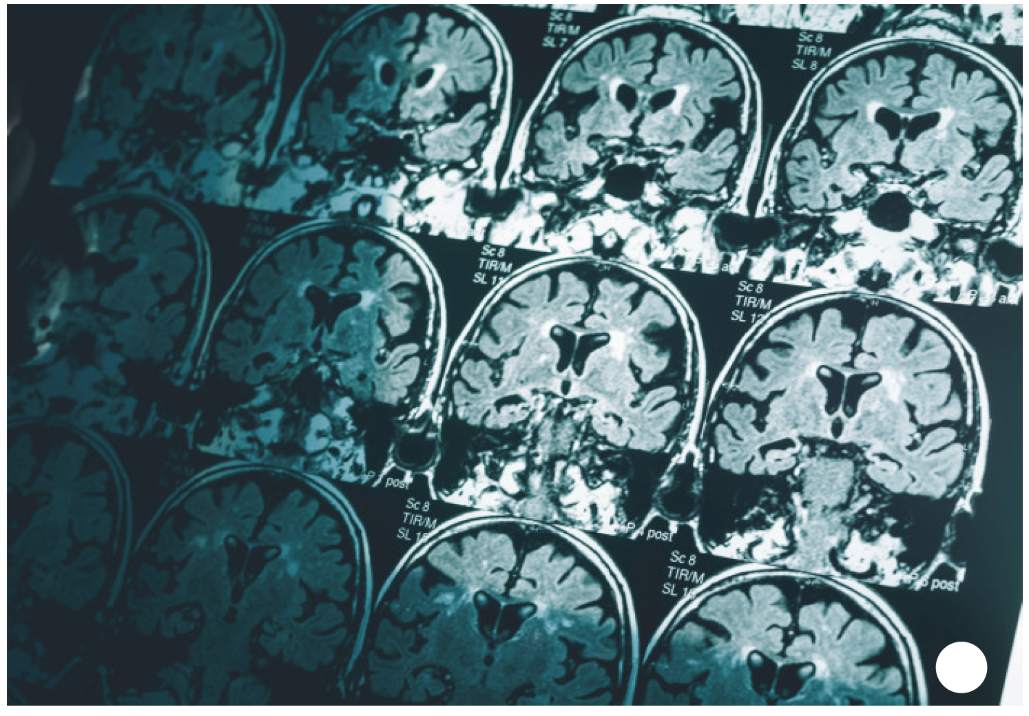 Long COVID Brain Fog Tied to Lung Function | Applied Radiology