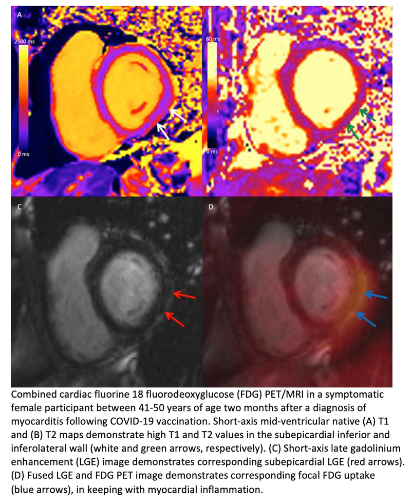 Heart Inflammation After COVID Vaccine Found Only in Patients With ...