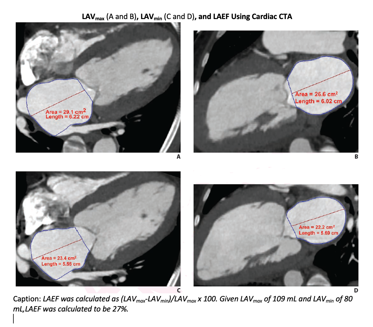 Cardiac CTA Parameters Predict Post-Transcatheter Aortic Valve ...