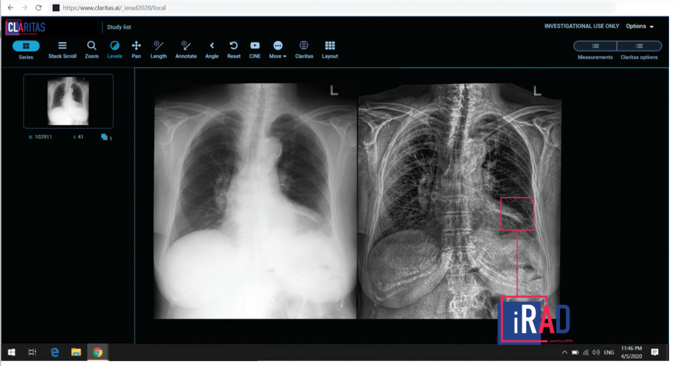 Claritas iRad Image Processing Software Gets FDA Nod | Applied Radiology