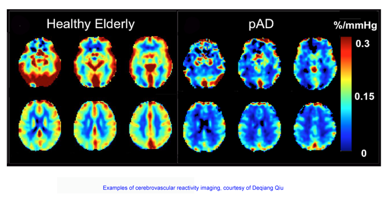 Emory Researchers to Advance Brain Imaging Techniques for Alzheimer’s ...