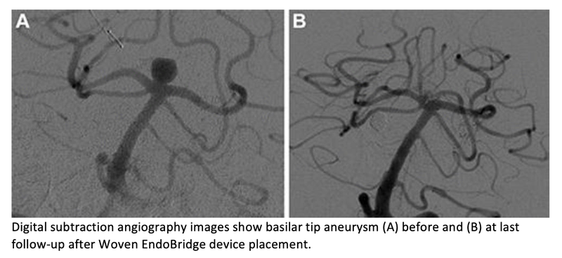 Novel Mesh Plug Also Effective for Sidewall Brain Aneurysm | Applied ...