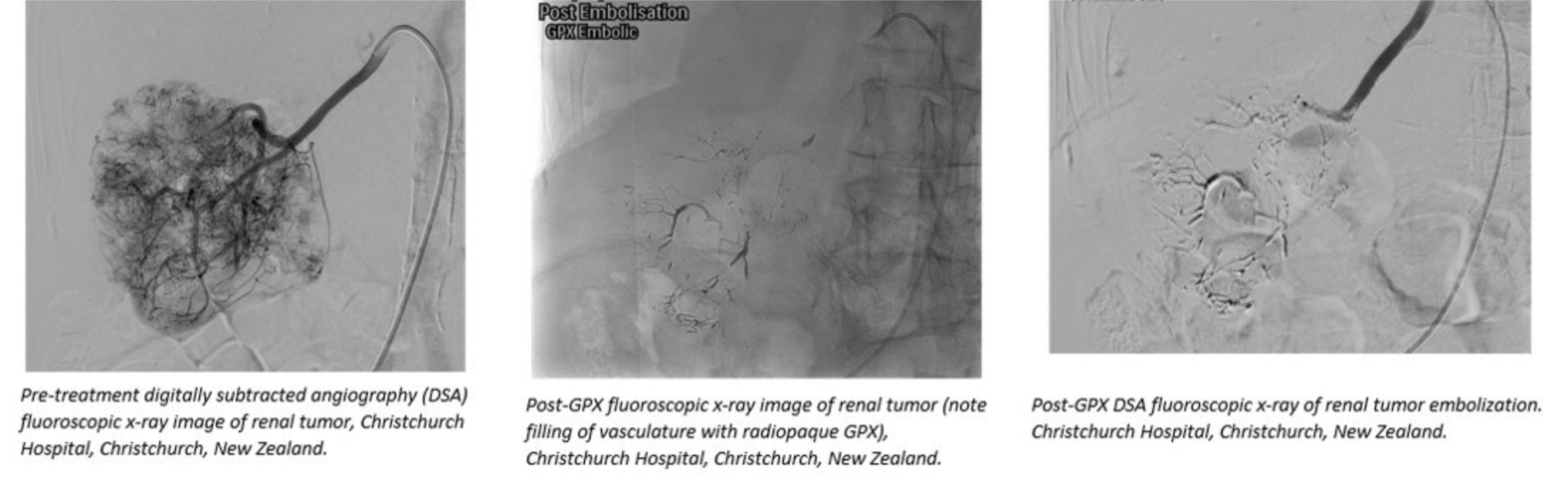 Investigational Embolic Device Selected for “Best of GEST” at Symposium ...