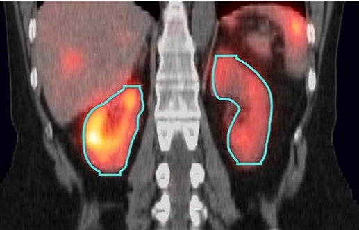 New AI Segmentation Models for Molecular Radiotherapy Get FDA Clearance ...