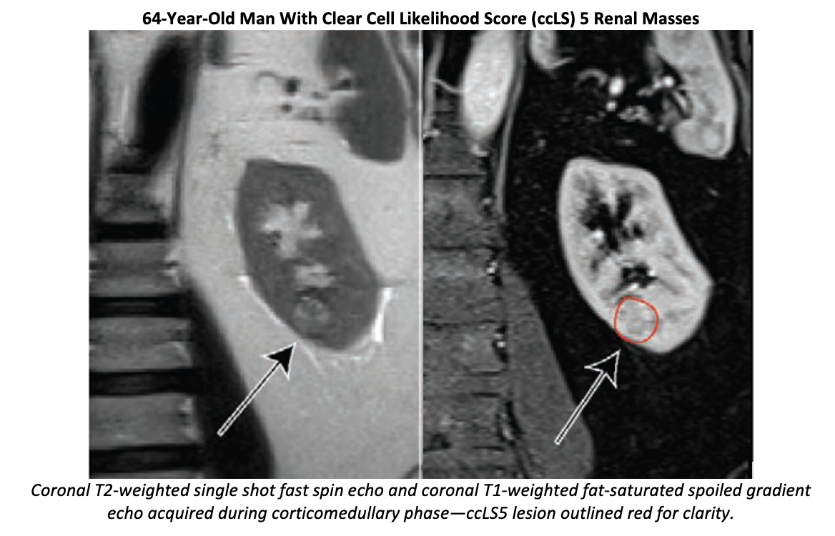 MRI Derived Score Correlates with Renal Mass Growth Rate | Applied ...