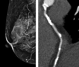 Breast arterial calcification: Indicator of coronary artery ...