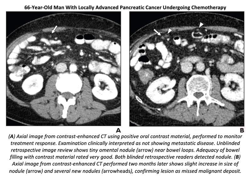Positive Oral Contrast With Optimized Bowel Prep Improves Detection of ...