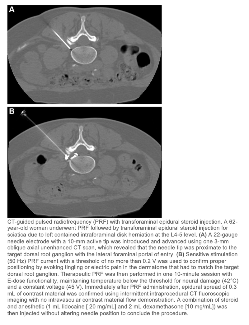 Steroids With Pulsed Radiofrequency Better at Relieving Sciatica Pain ...