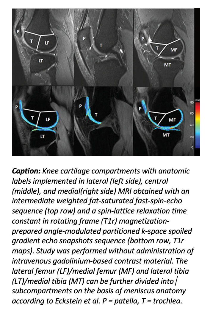 Knee Cartilage Grading Mri at Renee Andrzejewski blog