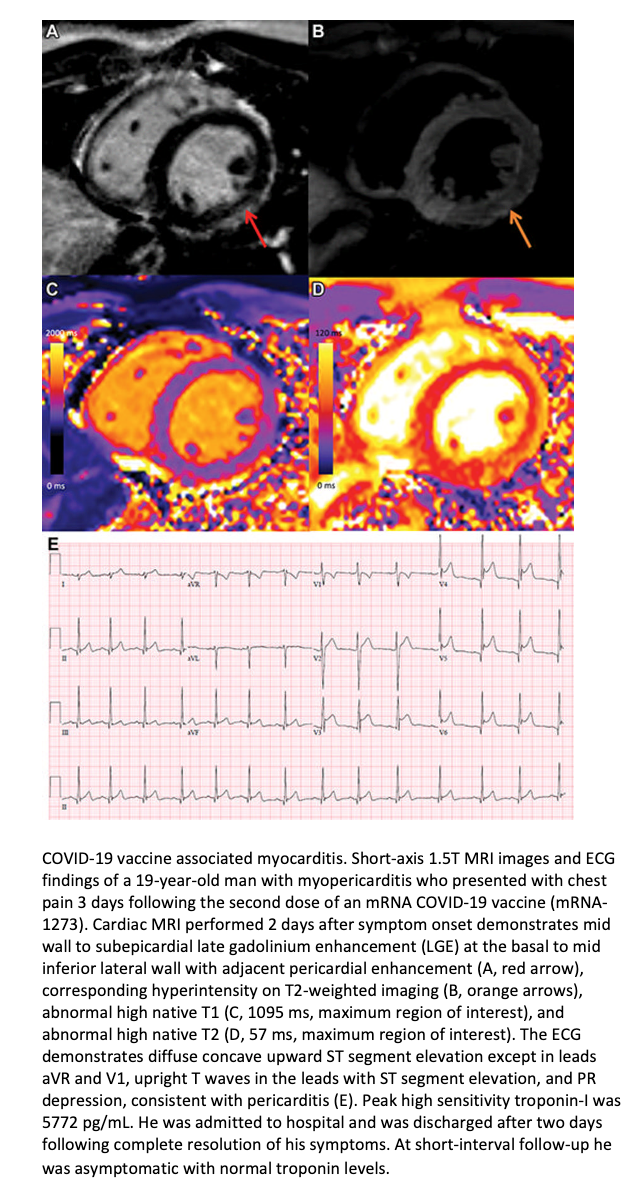 MRI Provides Insight on Vaccine-related Myocarditis | Applied Radiology