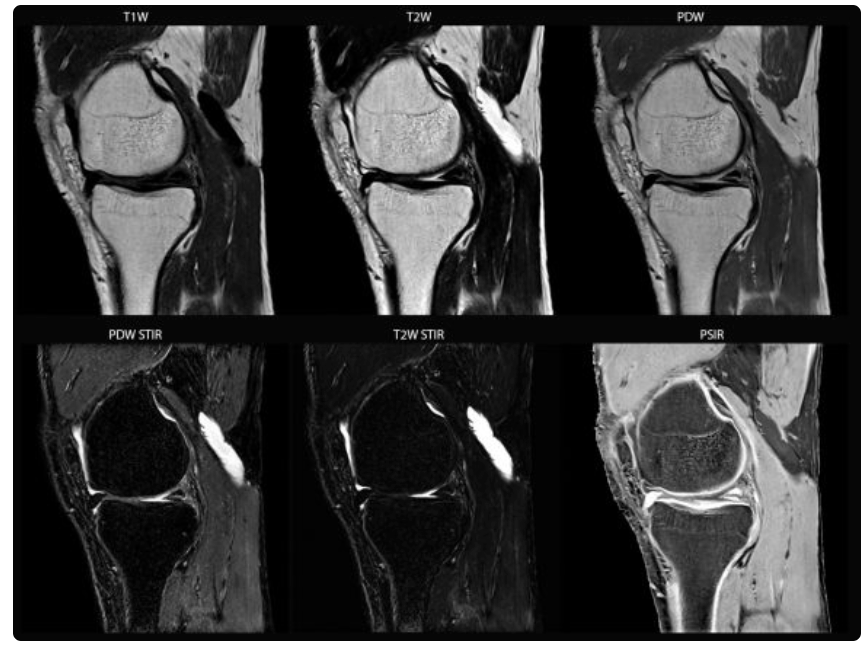 MRI May Be Best for Evaluating Hip, Knee Pain in Patients With ...