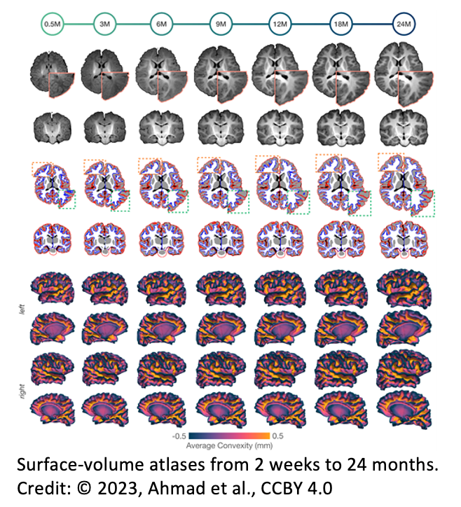 Infant Brain Atlases Unveiled by UNC Researchers | Applied Radiology