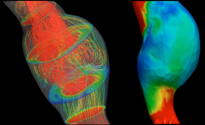 Image-Based Computational Model Predicts Early AAA Rupture • APPLIED ...