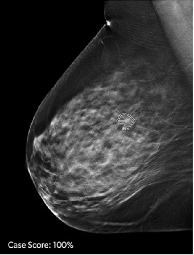 ProFound AI Version 3.0 for DBT gets FDA Clearance | Applied Radiology