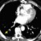 Pulmonary embolism in segmental and subsegmental arteries: Optimal ...