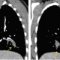 Pulmonary embolism in segmental and subsegmental arteries: Optimal ...