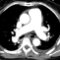 Pulmonary embolism in segmental and subsegmental arteries: Optimal ...