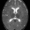 Pelizaeus-Merzbacher Syndrome