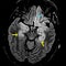 Article - MRI of Toxic, Metabolic, and Autoimmune Encephalopathies: A ...