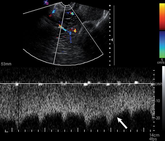 Ovarian Masses and O-RADS: A Systematic Approach to Evaluating and ...