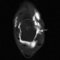 MR arthrography