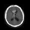 Intraventricular cavernoma