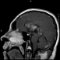 Intraventricular cavernoma